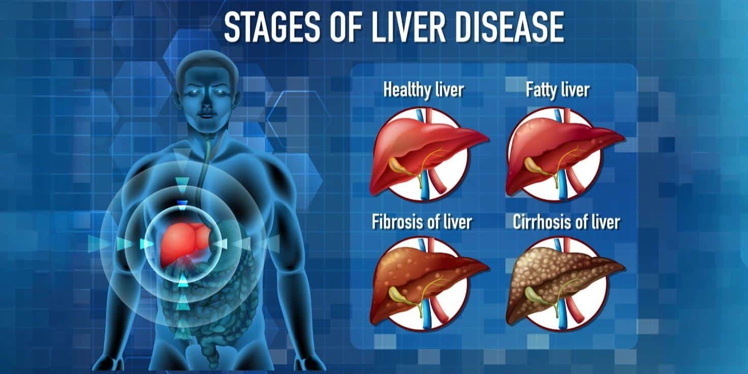 NAFLD: Causes, Symptoms, Risks & Prevention Methods